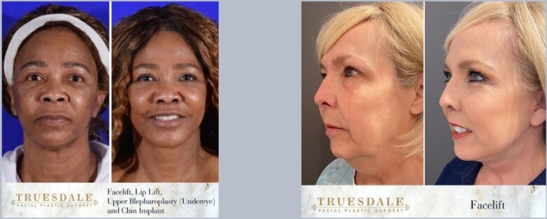 Renowned Beverly Hills Plastic Surgeon Dr. Carl Truesdale ⋆ Beverly ...